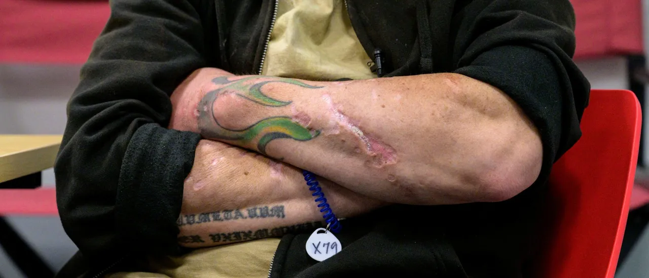 Flesh-Rotting Sedative Drug Leaches Into US Cocaine, Heroin, Pill ...