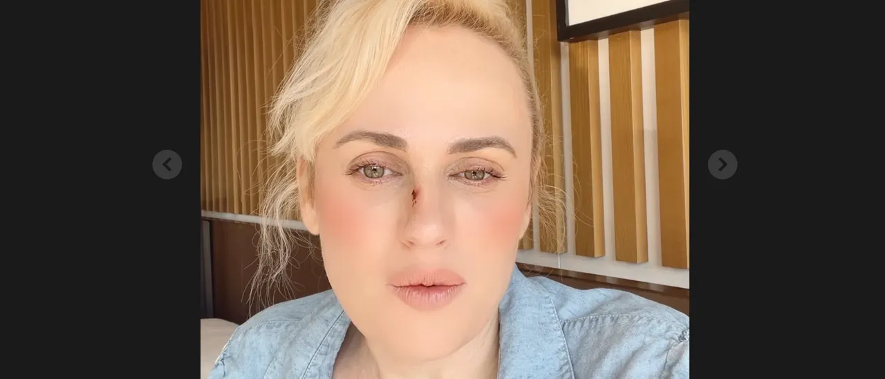 Rebel Wilson Reveals On-Set Injury After Being Hit In Face With A Gun ...