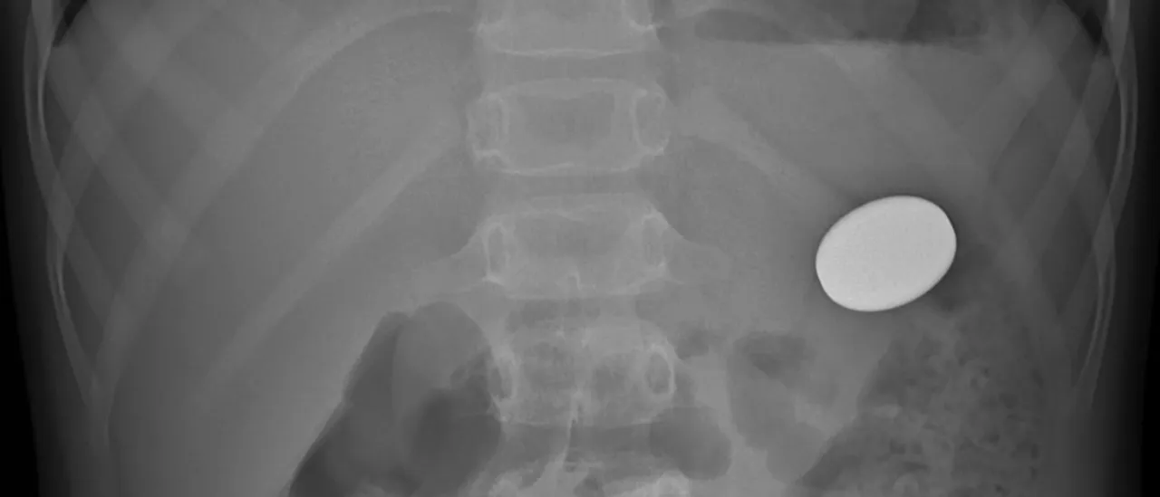 Shocking Number Of People Get ‘Foreign Objects’ Removed From Bodies ...